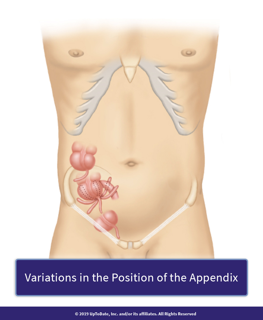 Appendicitis | Health Hippo